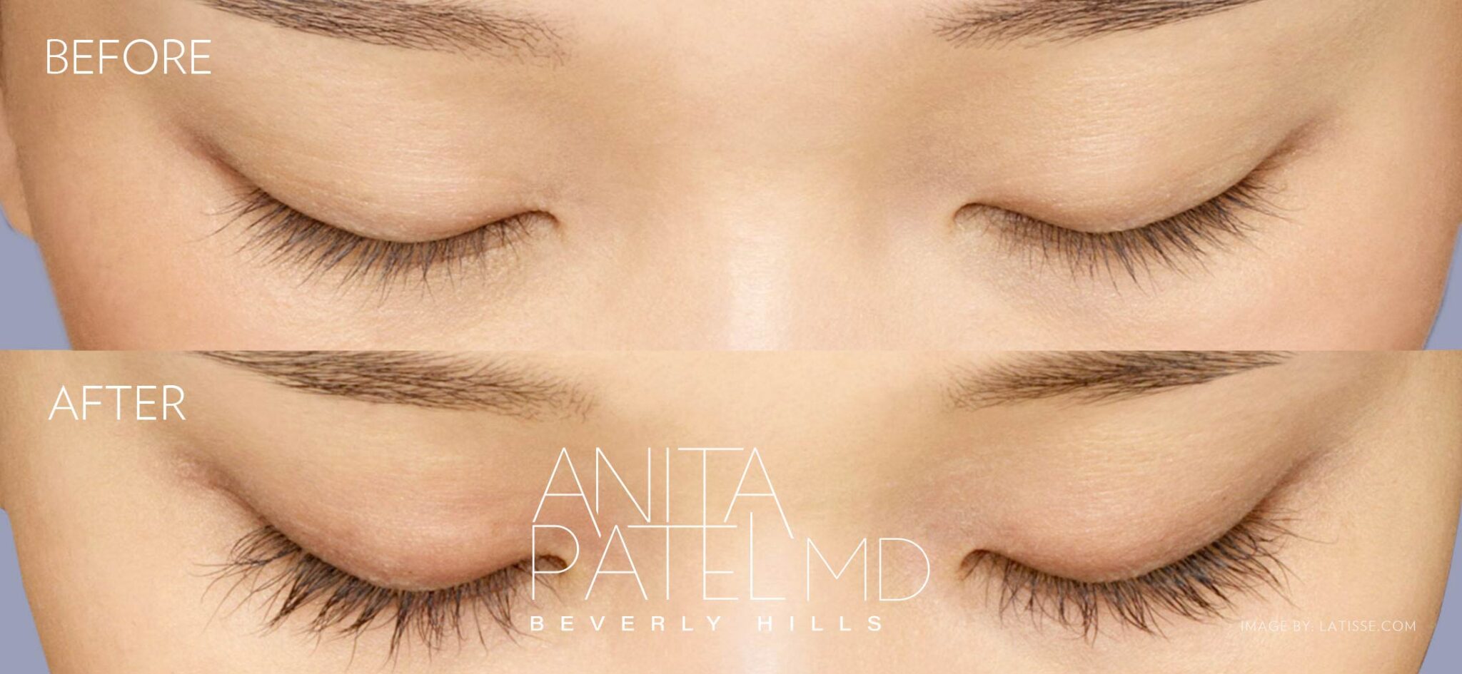 Eyelash Extensions Before & After Gallery - Dr. Anita Patel